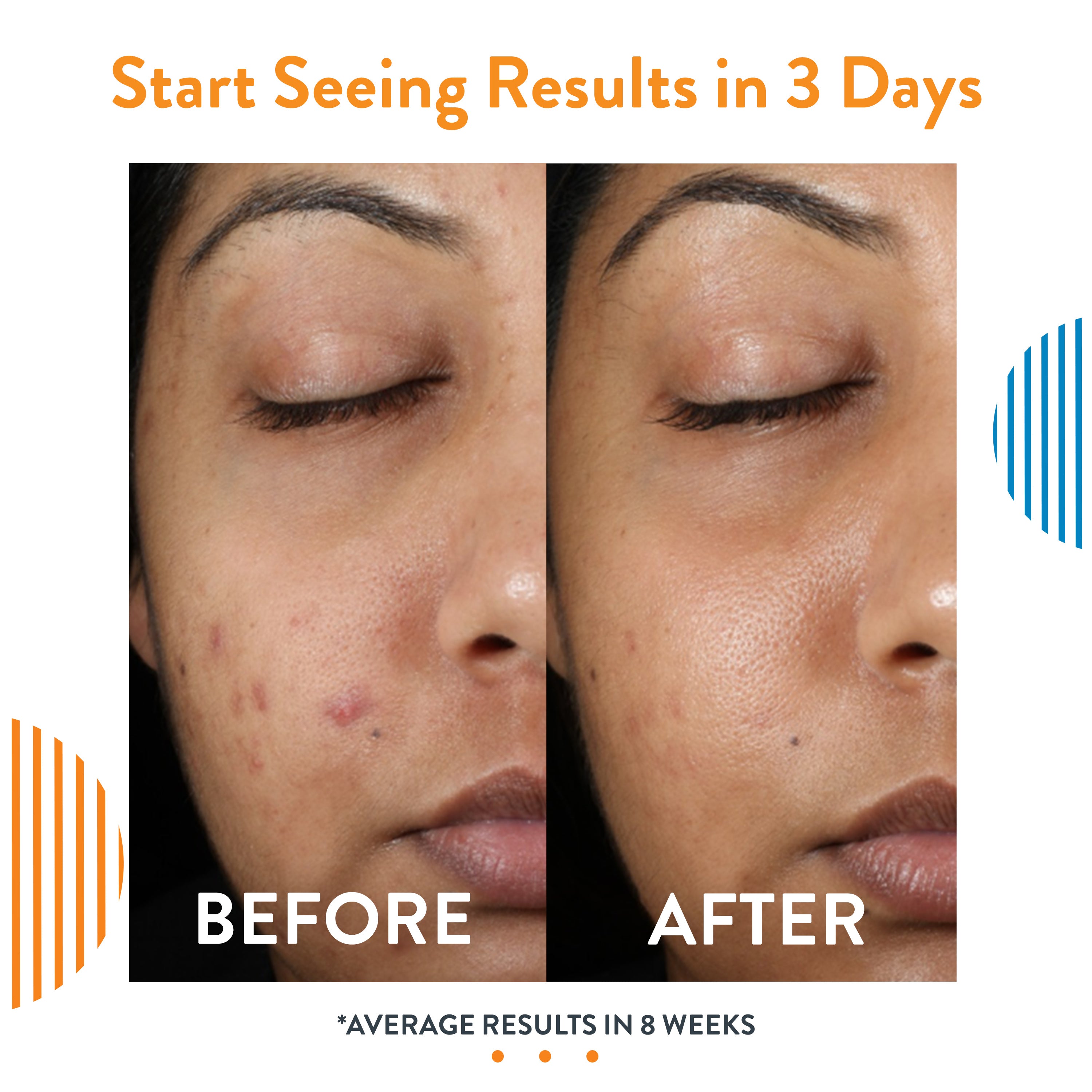 AcneFree Oil Free 24 HR Acne Clearing System 3PC Kit - AcneFree ...